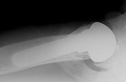 Zimmer Shoulder Prostheses