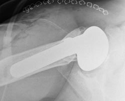 Zimmer Shoulder Prostheses