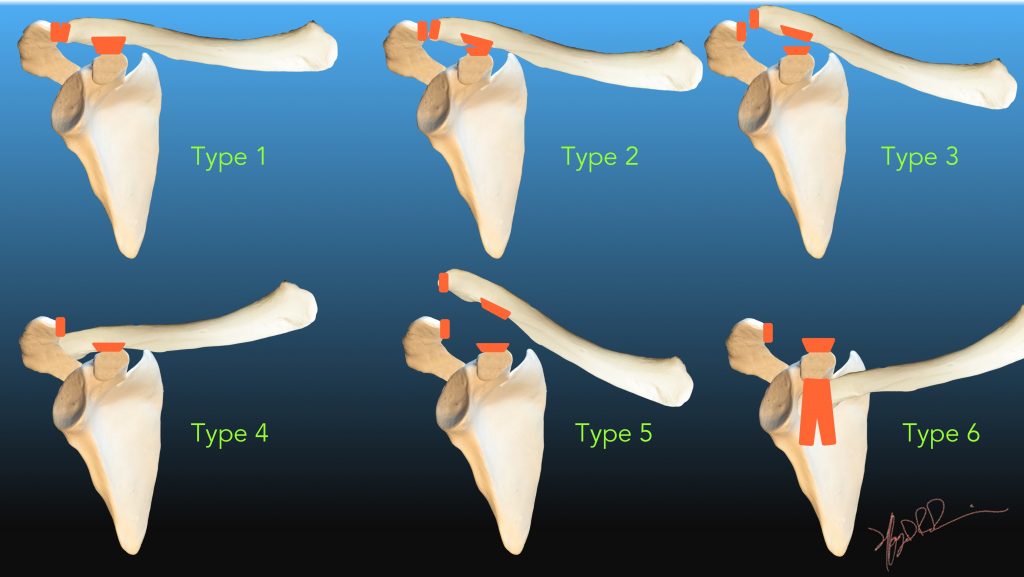 Rockwood Classification Of Acromioclavicular Joint Separation UW