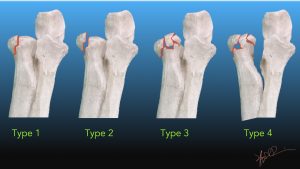 Mason-Johnston Classification of Radial Head Fractures | UW Emergency ...