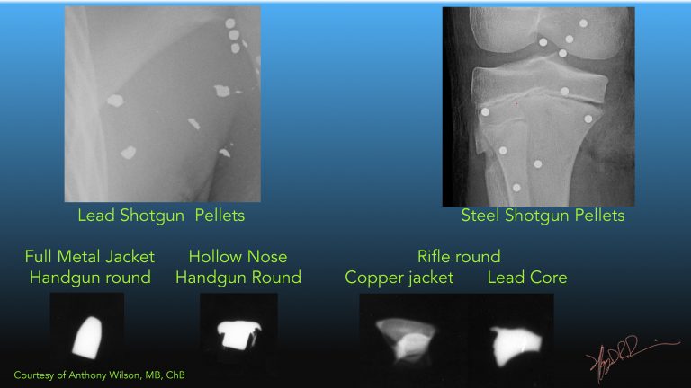 Basic Ballistics | UW Emergency Radiology