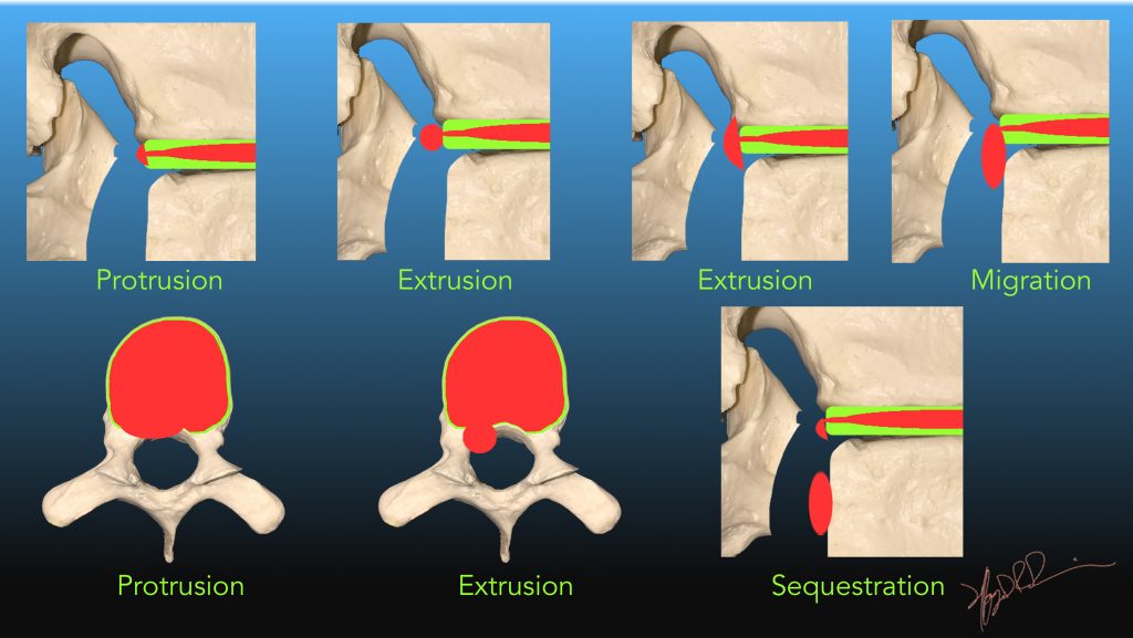 Nomenclature For Intervertebral Disc Herniation UW Emergency Radiology