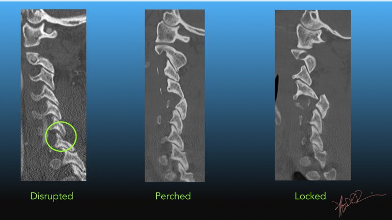 Facet Joint Injuries | UW Emergency Radiology