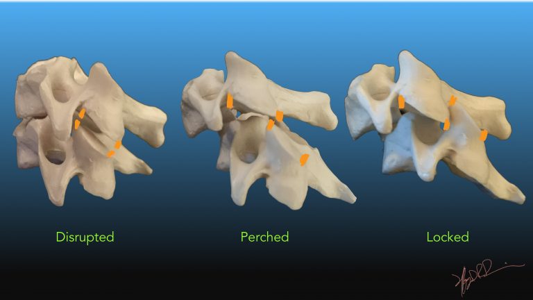 Facet Joint Injuries | UW Emergency Radiology
