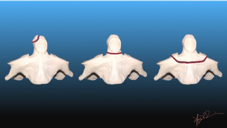 Anderson D’Alonzo Classification of Odontoid Fractures | UW Emergency ...