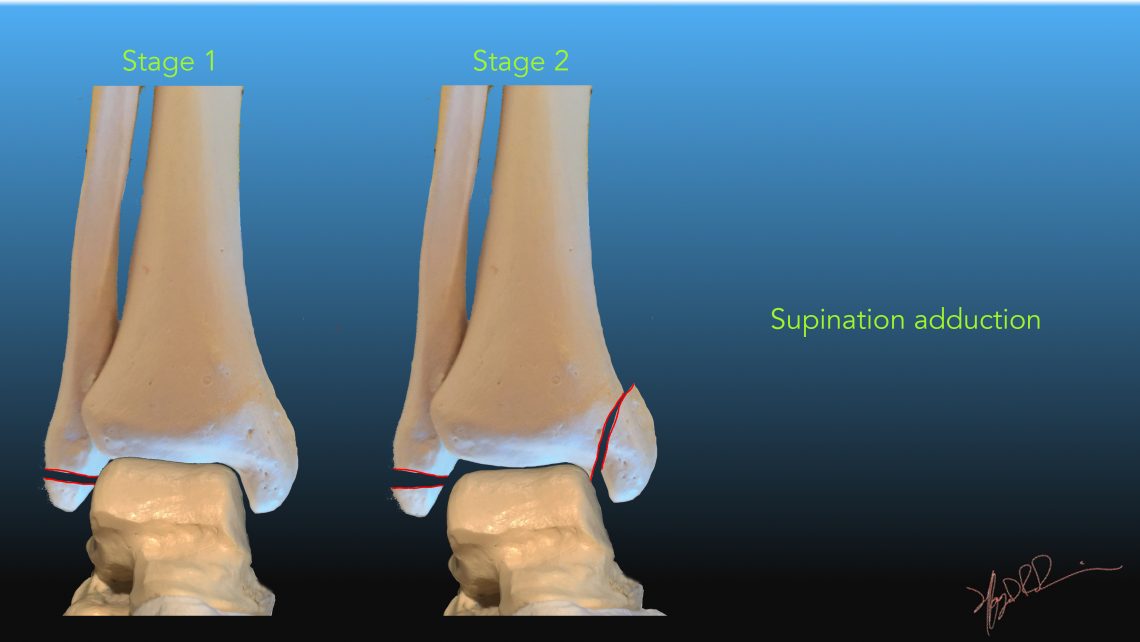 Lauge Hansen Classification of Ankle Fractures | UW Emergency Radiology