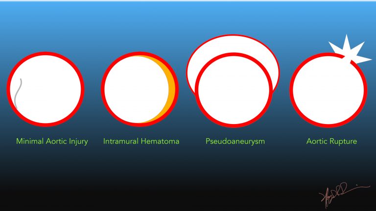 Classification of Blunt Traumatic Aortic Injury | UW Emergency Radiology
