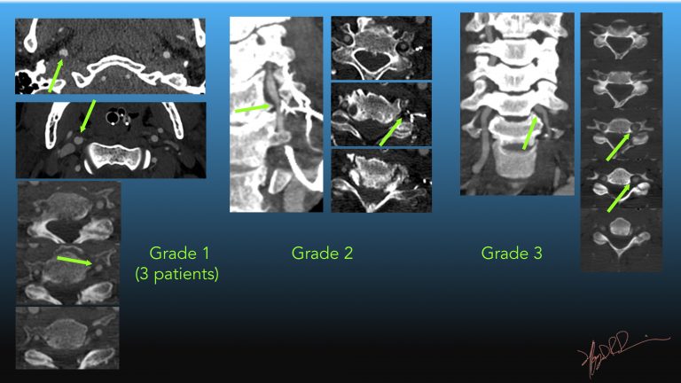 Biffl Classification of Cerebrovascular Injuries | UW Emergency Radiology