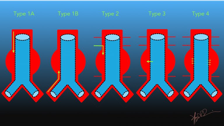 Classification of Aortic Stent-Graft Endoleaks | UW Emergency Radiology