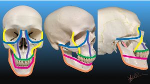 Maxillofacial Buttresses | UW Emergency Radiology