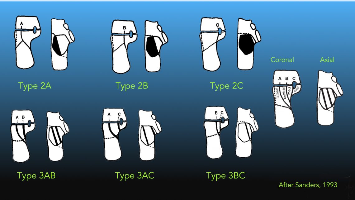 Sanders Classification of Calcaneal Fractures | UW Emergency Radiology
