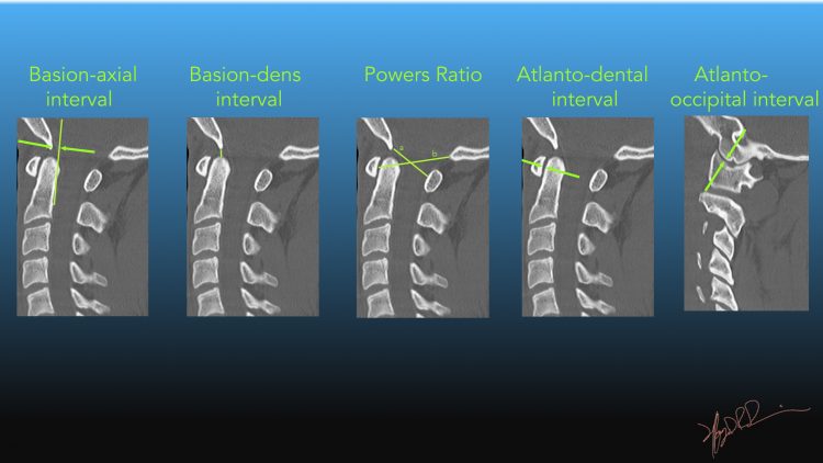 Normal Adult Craniocervical Measurements on CT | UW Emergency Radiology