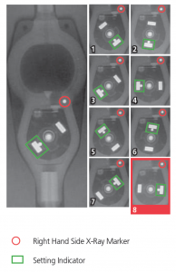 Determining Settings of Programmable VP Shunts | UW Emergency Radiology