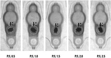 Determining Settings of Programmable VP Shunts | UW Emergency Radiology