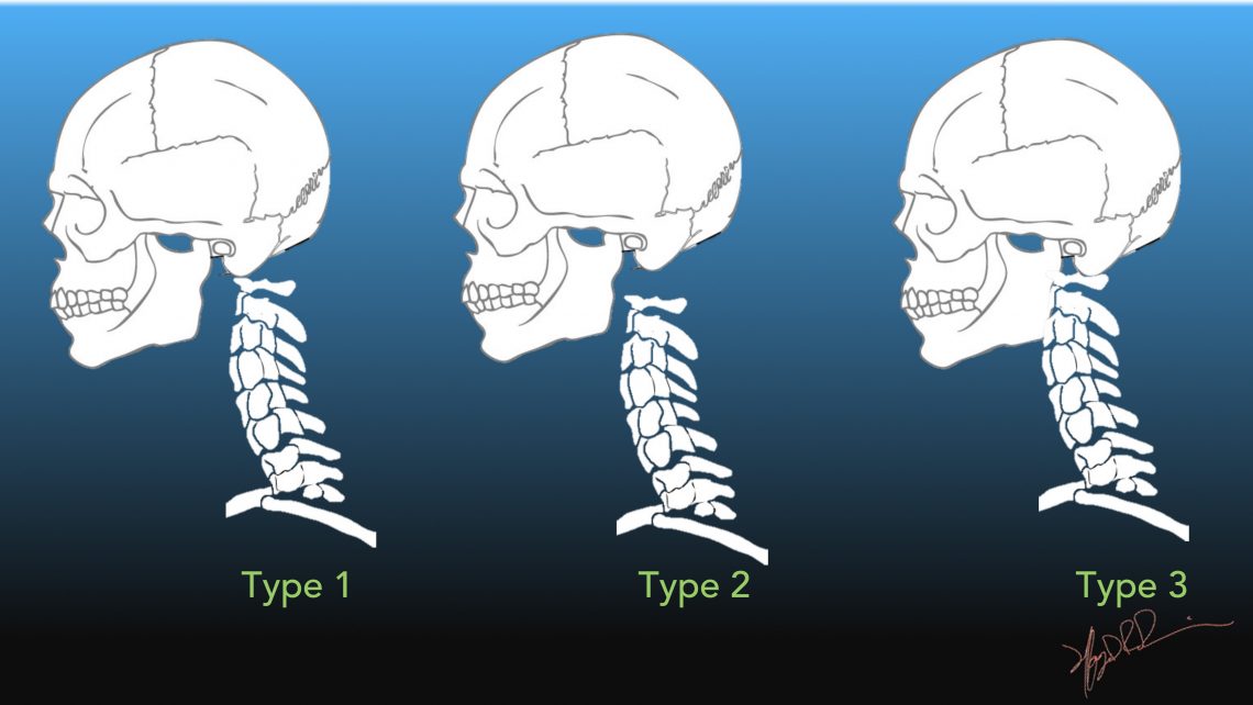 Atlanto-occipital Dissociation | UW Emergency Radiology
