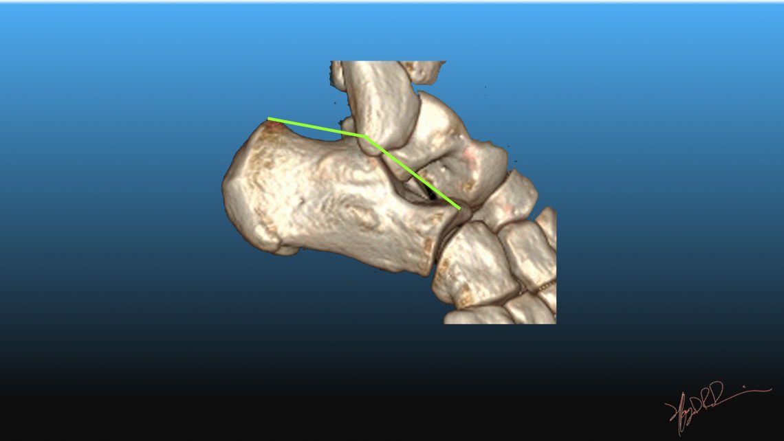 Bohler angle | UW Emergency Radiology