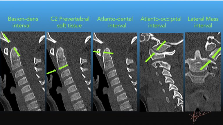 Normal Pediatric Craniocervical Measurements | UW Emergency Radiology